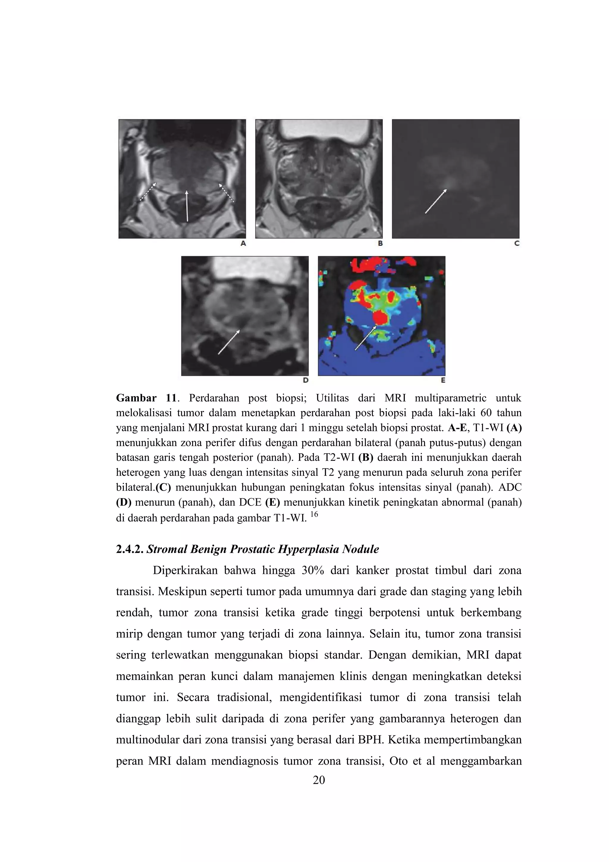 dr. Adnan (Referat) Gambaran MRI Kanker Prostat.pdf