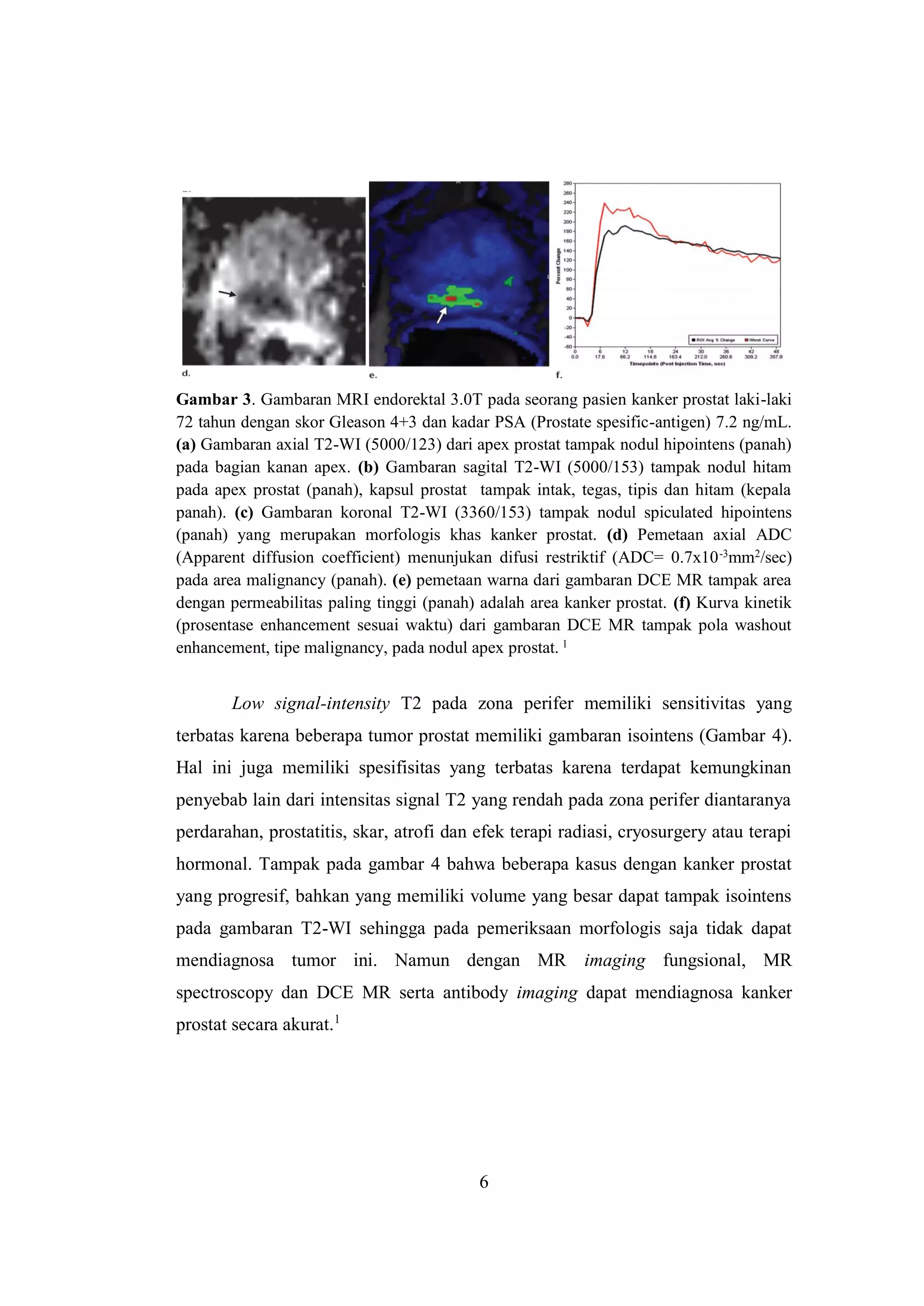 dr. Adnan (Referat) Gambaran MRI Kanker Prostat.pdf