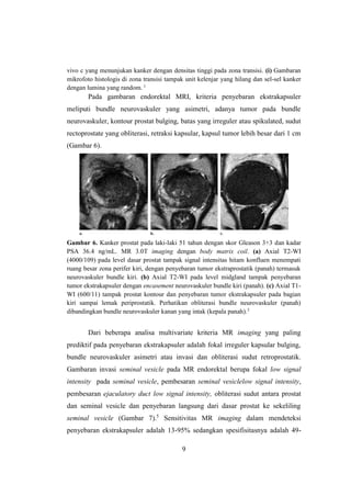 dr. Adnan (Referat) Gambaran MRI Kanker Prostat.pdf