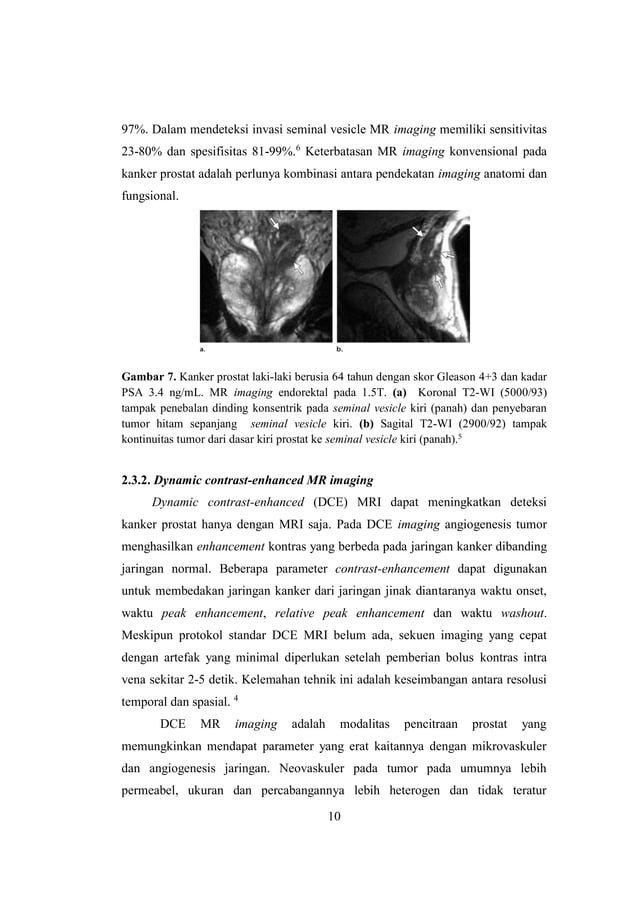 dr. Adnan (Referat) Gambaran MRI Kanker Prostat.pdf