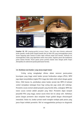 dr. Adnan (Referat) Gambaran MRI Kanker Prostat.pdf