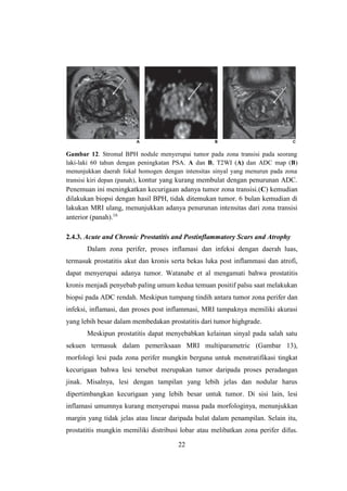 dr. Adnan (Referat) Gambaran MRI Kanker Prostat.pdf