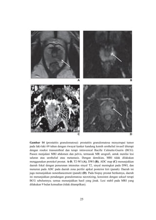 dr. Adnan (Referat) Gambaran MRI Kanker Prostat.pdf