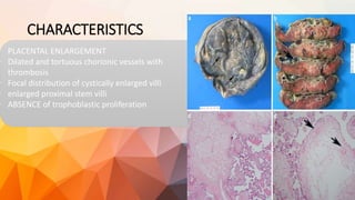 placental mesenchymal dysplasia pptx | PPT