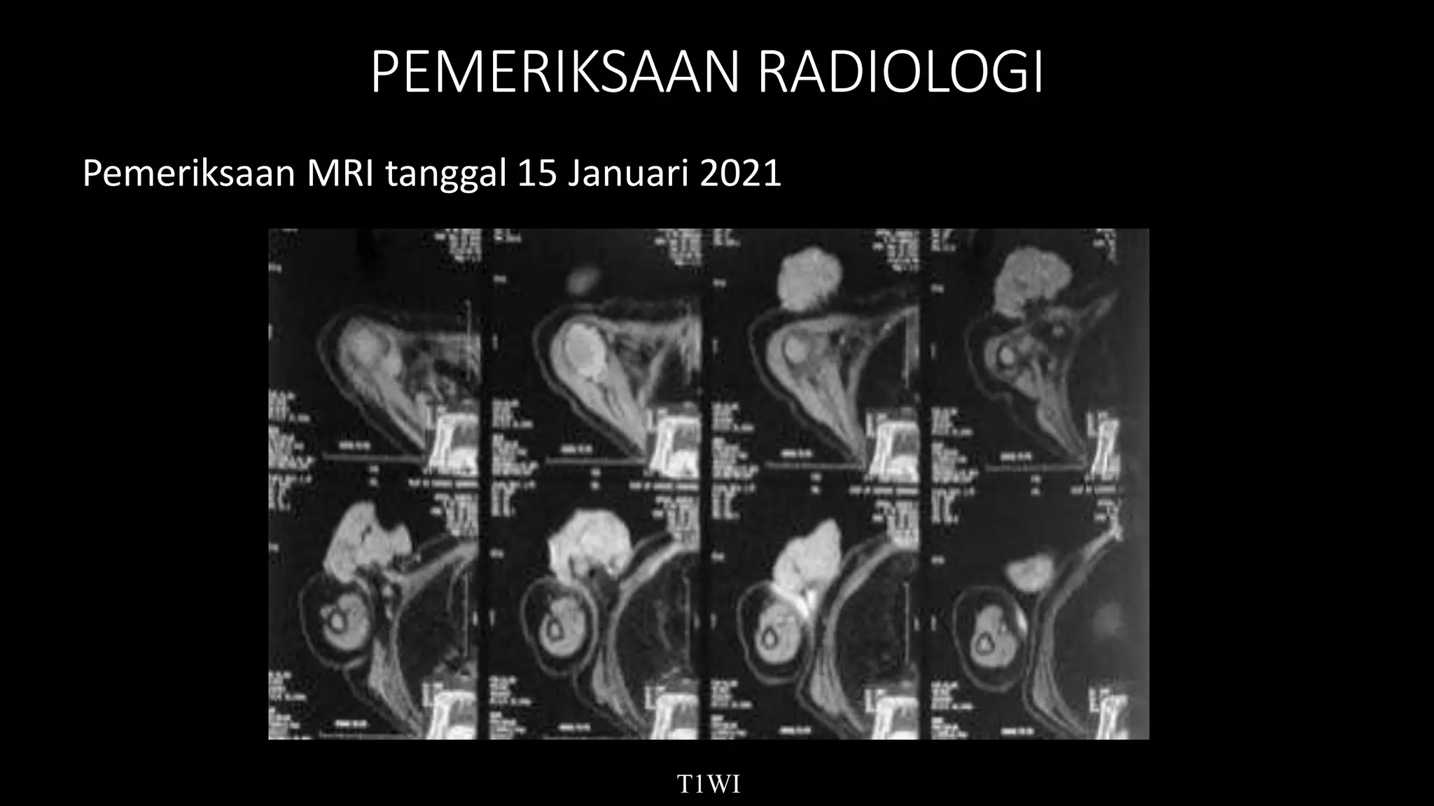 dr. Nani PPT (Kasus) Embolisasi pada Infantil Hemangioma (1).pptx