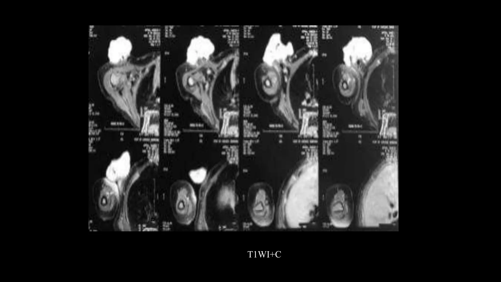 dr. Nani PPT (Kasus) Embolisasi pada Infantil Hemangioma (1).pptx
