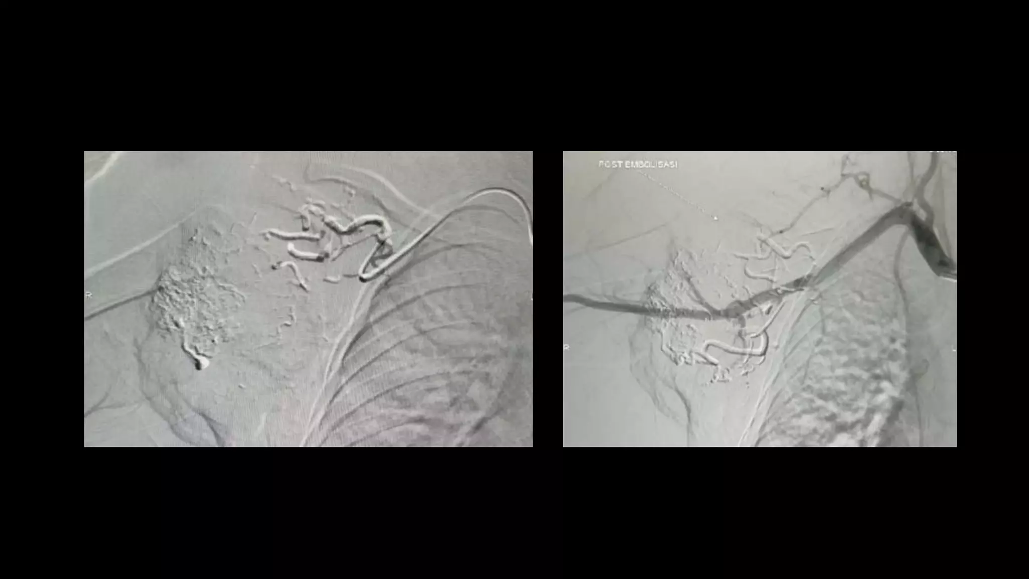 dr. Nani PPT (Kasus) Embolisasi pada Infantil Hemangioma (1).pptx
