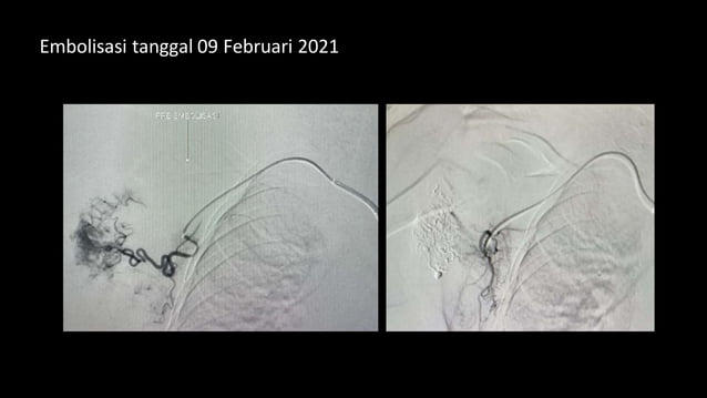 dr. Nani PPT (Kasus) Embolisasi pada Infantil Hemangioma (1).pptx