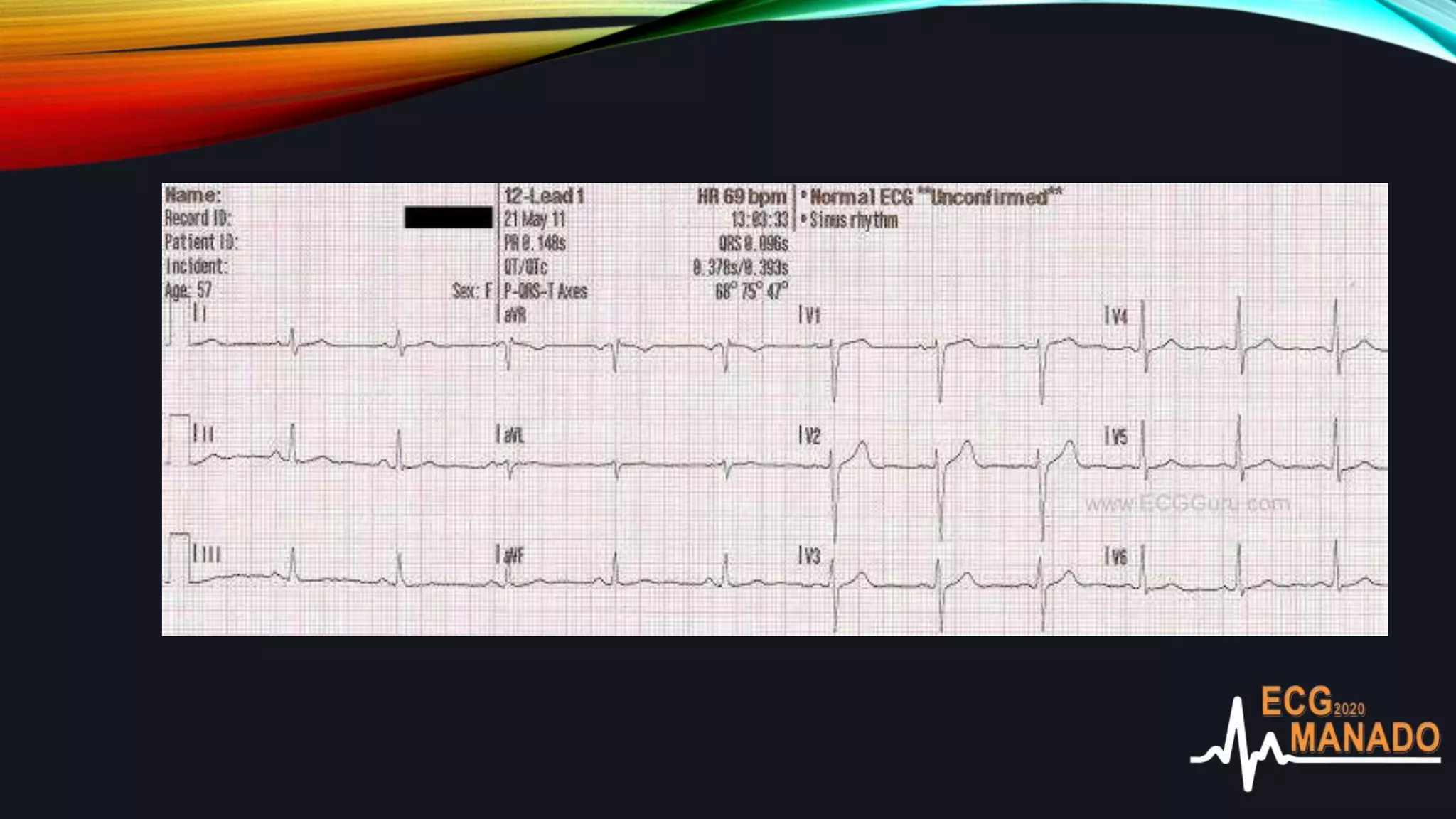dr. BS - Basic cardiac EP ECG course.pptx