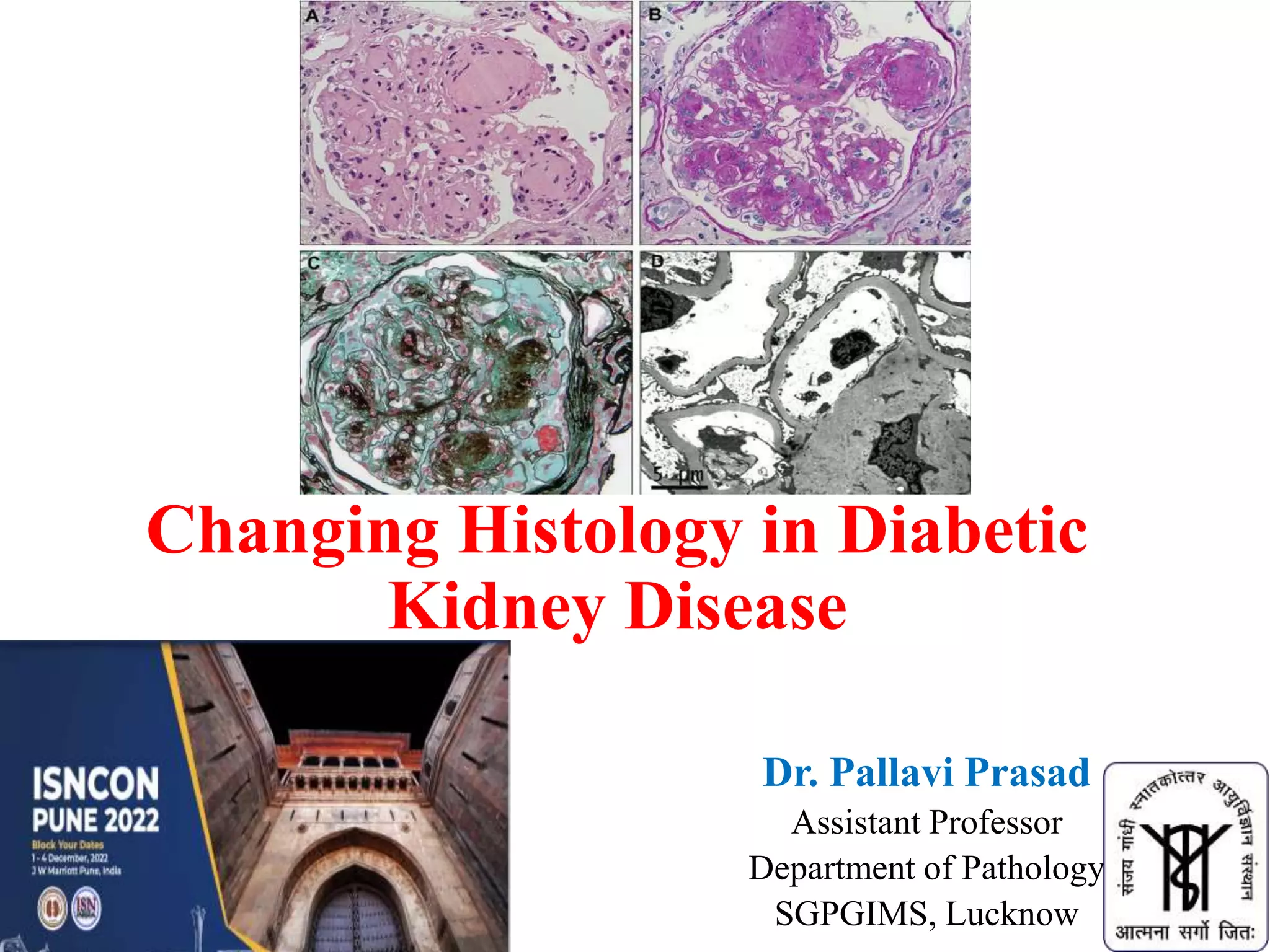 Changing histology in diabetic kidney disease | PPTX
