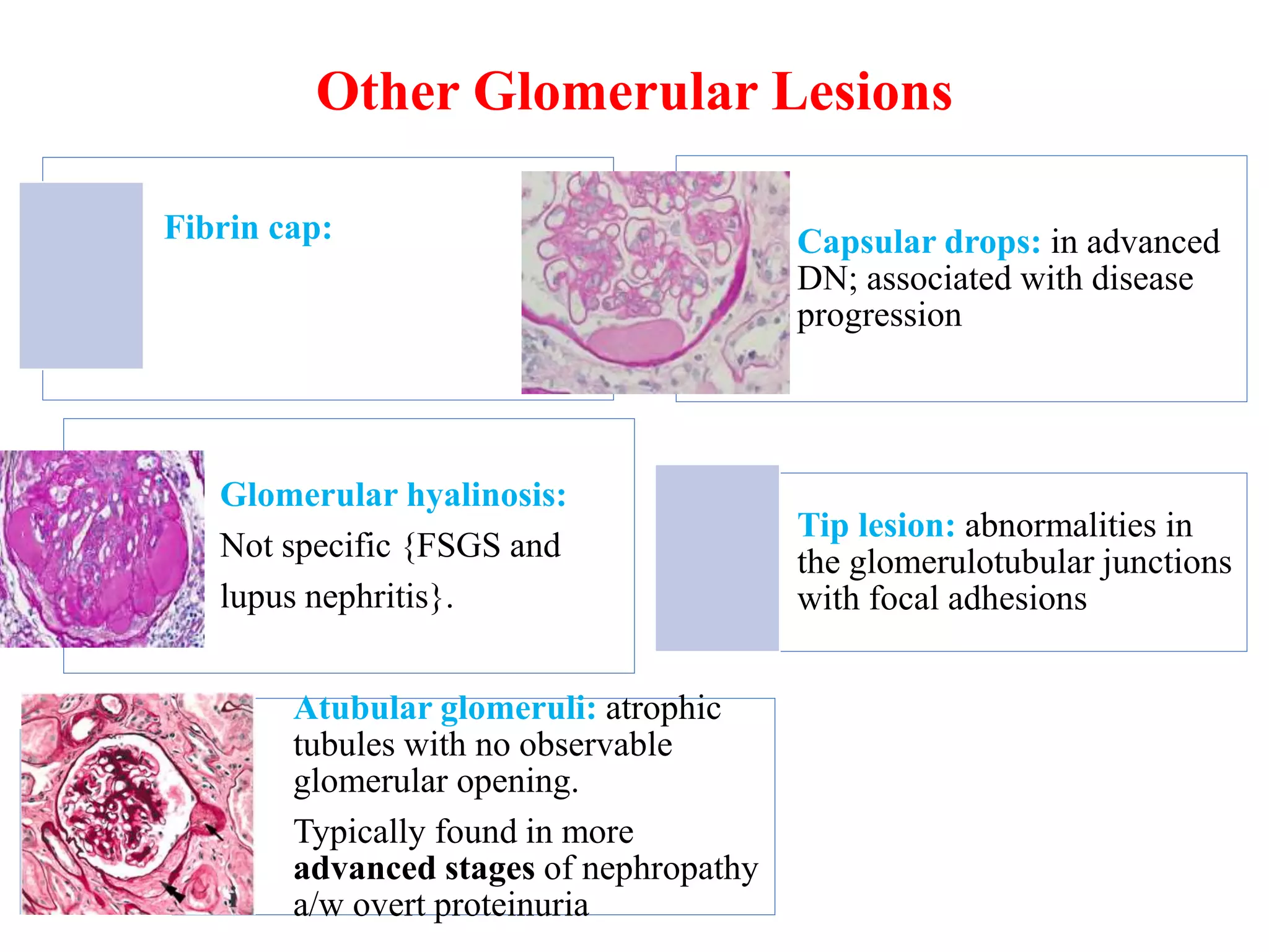 Changing histology in diabetic kidney disease | PPTX