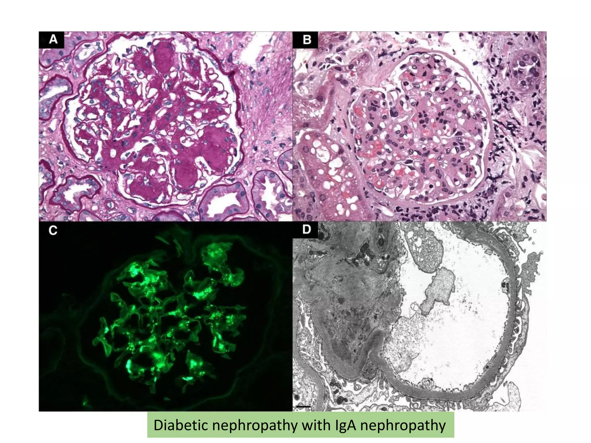 Changing histology in diabetic kidney disease | PPTX