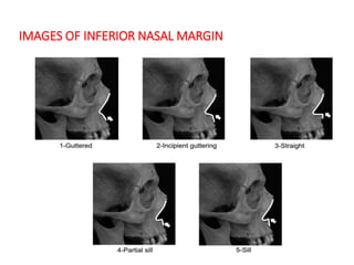 DETERMINATION OF RACE FROM HUMAN REMAINS.pptx Dr. Haricharan MD RIMS ...