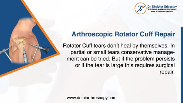 Rotator Cuff Tear Arthroscopy, Rotator Cuff Surgery and Repair by Dr ...