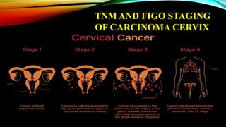 DR.NNC INVASIVE CERVICAL CARCINOMA 20092023.pptx