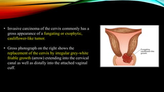 DR.NNC INVASIVE CERVICAL CARCINOMA 20092023.pptx