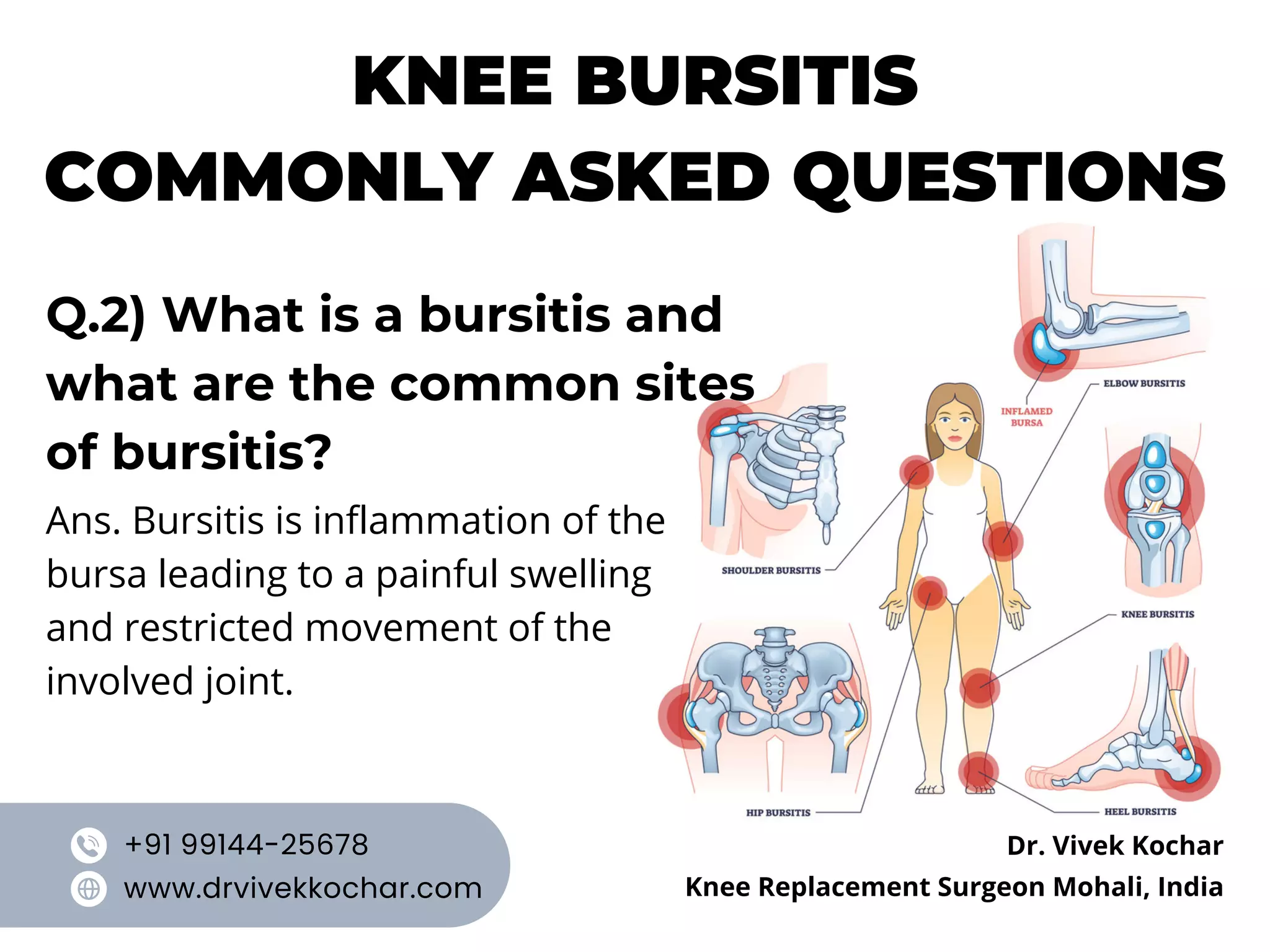 All about Knee Bursitis by Dr. Vivek Kochar Mohali Orthopedic Doctor | PDF