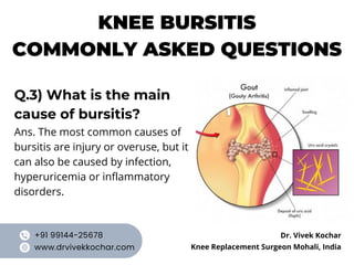 All about Knee Bursitis by Dr. Vivek Kochar Mohali Orthopedic Doctor | PDF