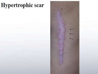 Dr. Nawaz Dal HYPERTROPHIC SCAR AND KELOID SCAR.pptx