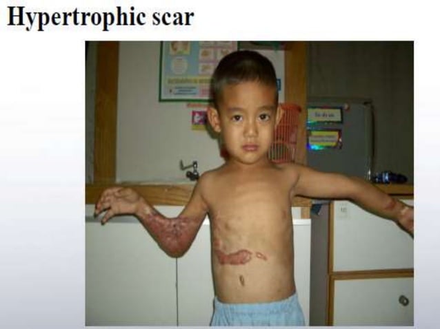 Dr. Nawaz Dal HYPERTROPHIC SCAR AND KELOID SCAR.pptx