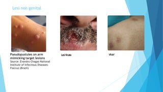 dr.Putu_Monkeypox ppt23_RSPISS.pdf