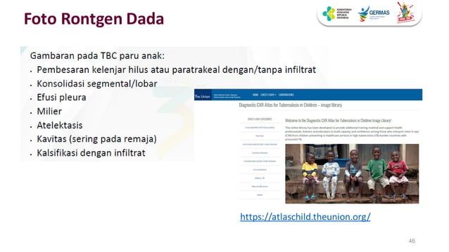 dr. Irma, Sp.A(K) Update Tatalaksana Tuberkulosis Anak & Remaja.pdf