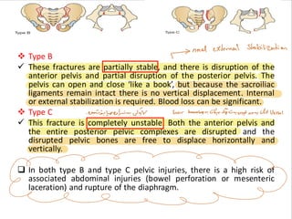 pelvis trauma & damage control surgery and its management | PPT