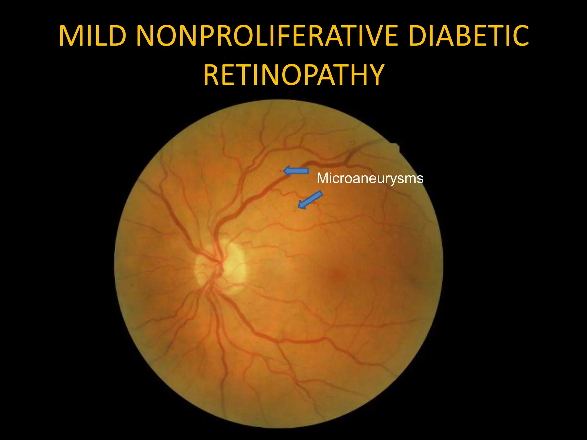 diabetic retinopathy detection using cnn | PPT