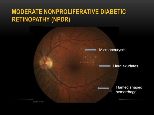 diabetic retinopathy detection using cnn | PPT