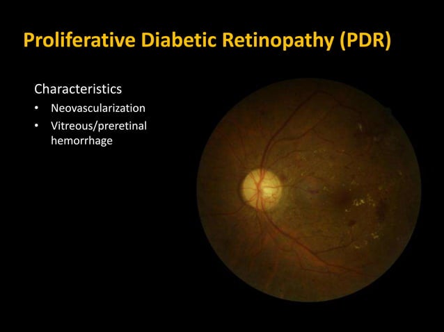 diabetic retinopathy detection using cnn | PPT