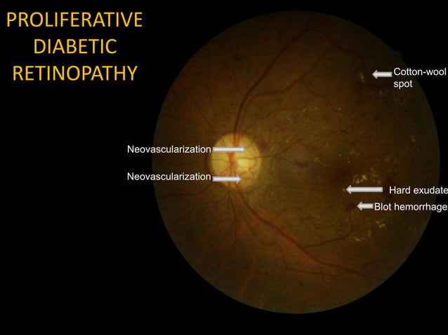 diabetic retinopathy detection using cnn | PPT