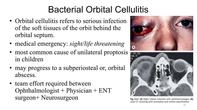 Preseptal Cellulitis & Orbital Cellulitis -Dr. Prabhat Devkota.pptx | Ear, Nose and Throat ...