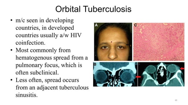 Preseptal Cellulitis & Orbital Cellulitis -Dr. Prabhat Devkota.pptx ...