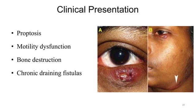 Preseptal Cellulitis & Orbital Cellulitis -Dr. Prabhat Devkota.pptx | Ear, Nose and Throat ...