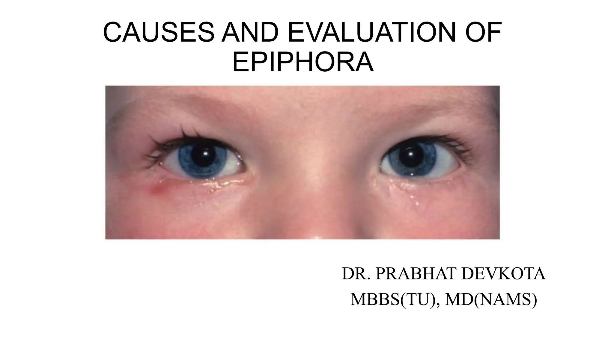 CAUSES AND EVALUATION OF EPIPHORA-DR.PRABHAT DEVKOTA.pptx | Eye and ...