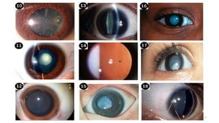 Congenital Cataract Surgery, Dr. Prabhat Devkota.pptx