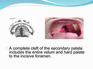 Dr. Saad Gasgus cleft lip and palate-1 (Muhadharaty).ppt