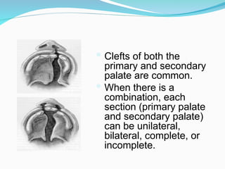 Dr. Saad Gasgus cleft lip and palate-1 (Muhadharaty).ppt