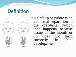 Dr. Saad Gasgus cleft lip and palate-1 (Muhadharaty).ppt | Ear, Nose ...