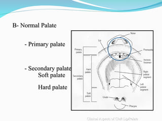Dr. Saad Gasgus cleft lip and palate-1 (Muhadharaty).ppt