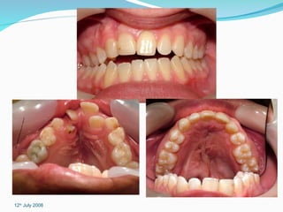 Dr. Saad Gasgus cleft lip and palate-1 (Muhadharaty).ppt