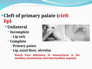 Dr. Saad Gasgus cleft lip and palate-1 (Muhadharaty).ppt