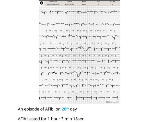 Dr. kush JHRS 2024 External loop recorder.pptx