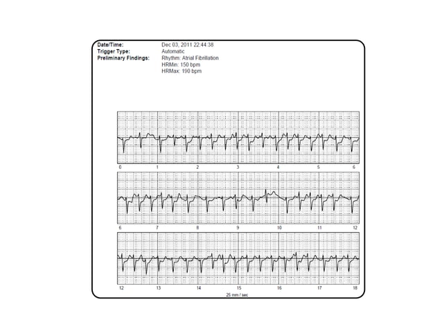 Dr. kush JHRS 2024 internal loop recorder (1).pptx