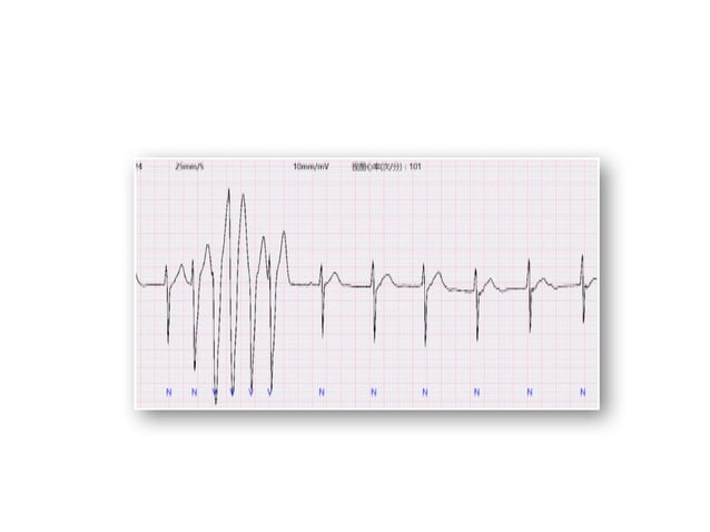 Dr. kush JHRS 2024 internal loop recorder (1).pptx