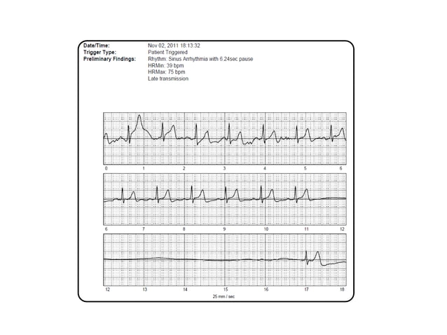Dr. kush JHRS 2024 internal loop recorder (1).pptx