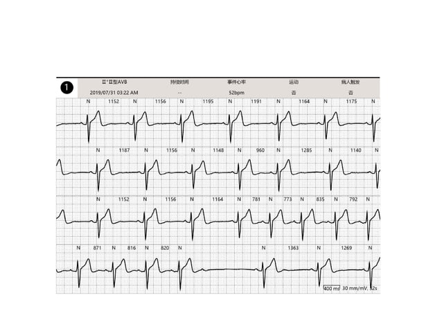 Dr. kush JHRS 2024 internal loop recorder (1).pptx