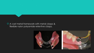 diagnosis and treatment planning of removable partial dentures | PPTX