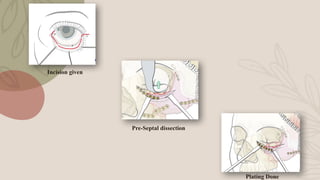 Zygomatic Orbital Fracture : The Lower Blephroplasty Incision as a ...