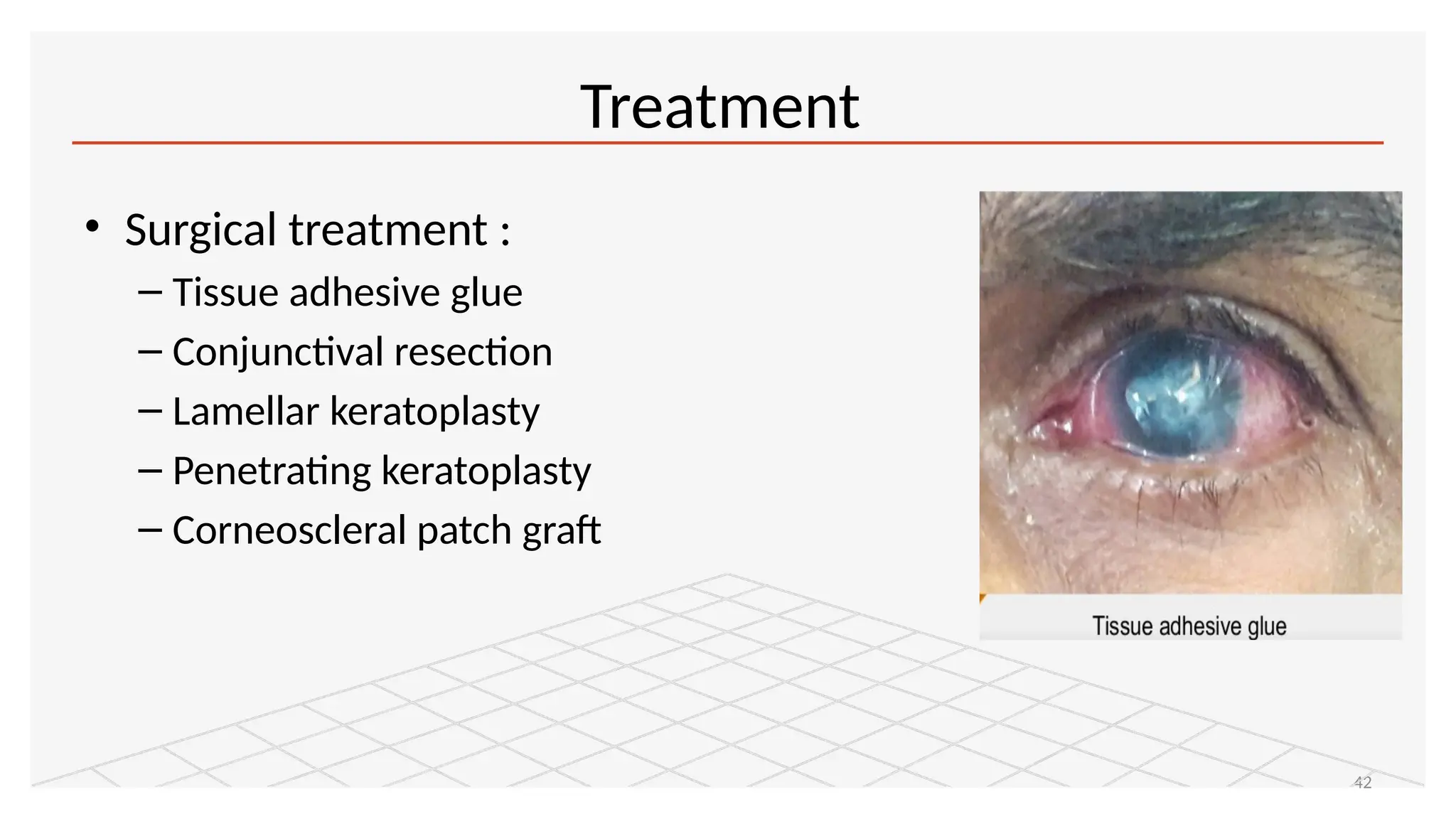 Peripheral Ulcerative Keratitis & Mooren’s Ulcer- Dr. Prabhat Devkota.pptx